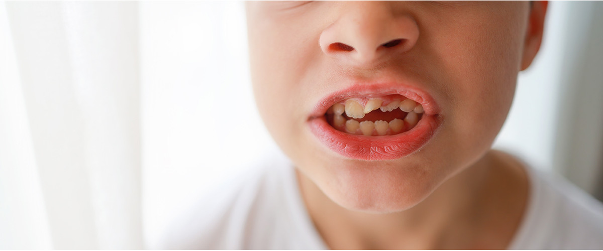 Cleft Lip and Palate Orthodontic Treatment in San Antonio | Amini Ortho